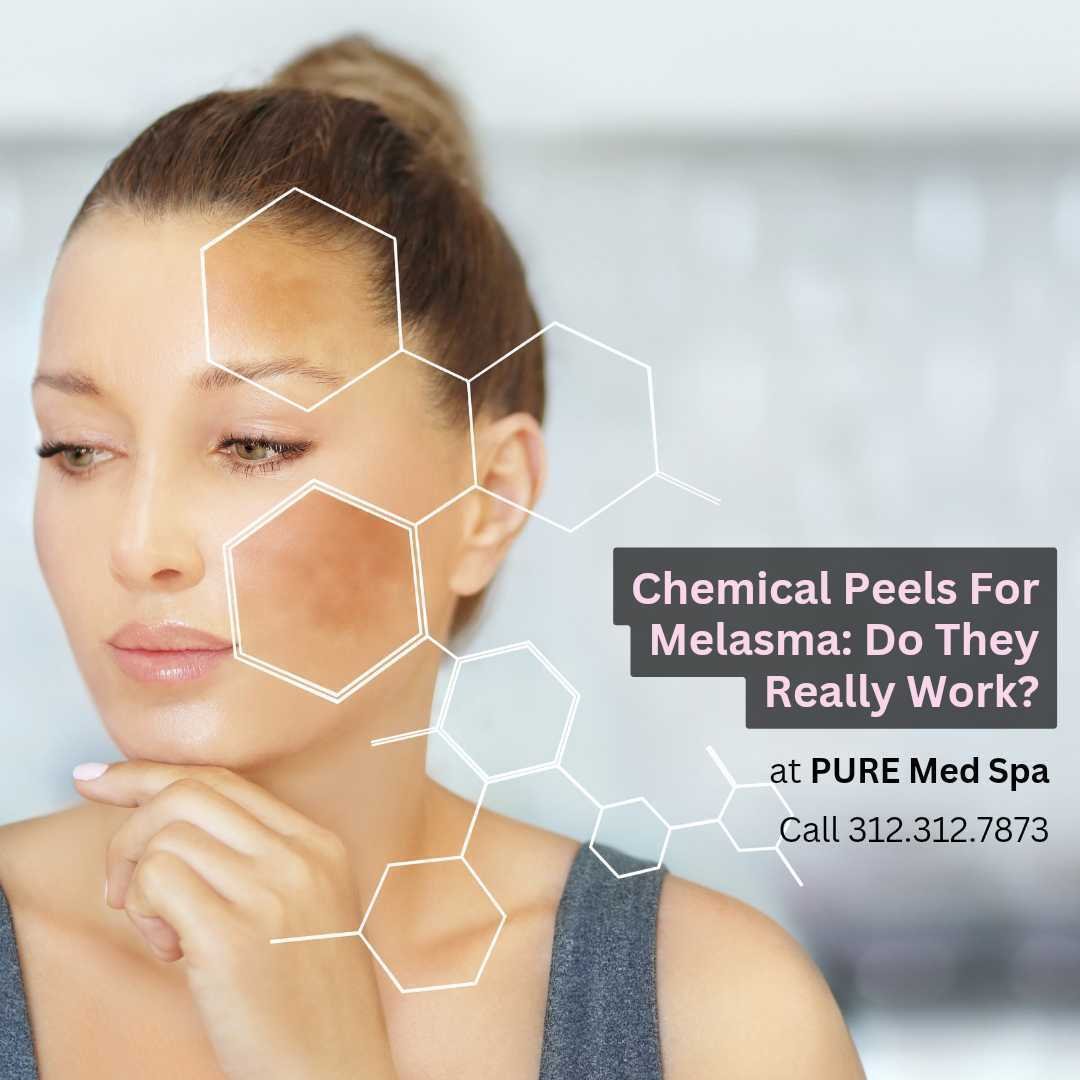 Chemical Peels For Melasma: Do They Really Work? - PURE Medical Spa