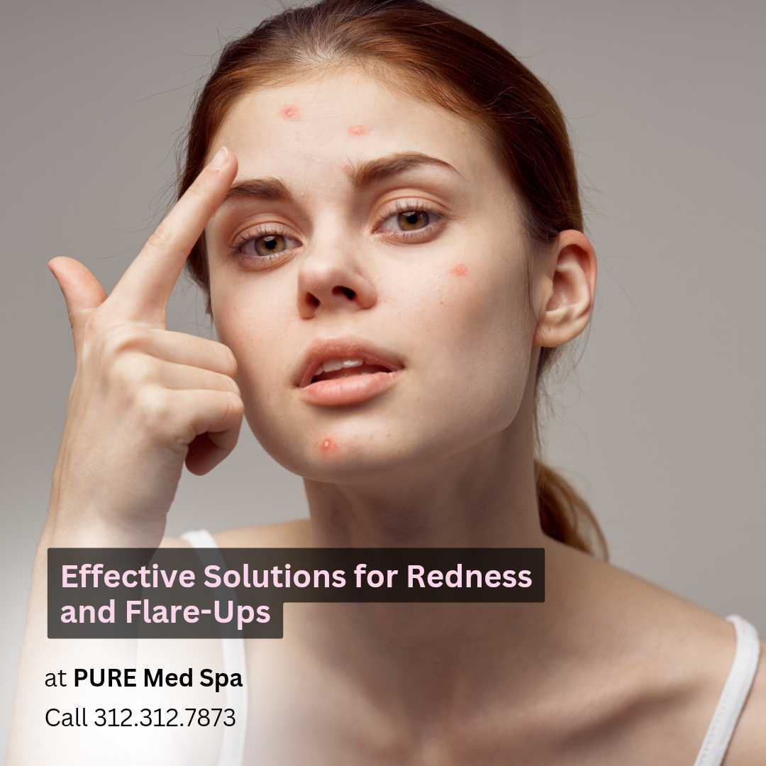 Effective Solutions for Redness and Flare-Ups at Chicago - PURE Medical Spa