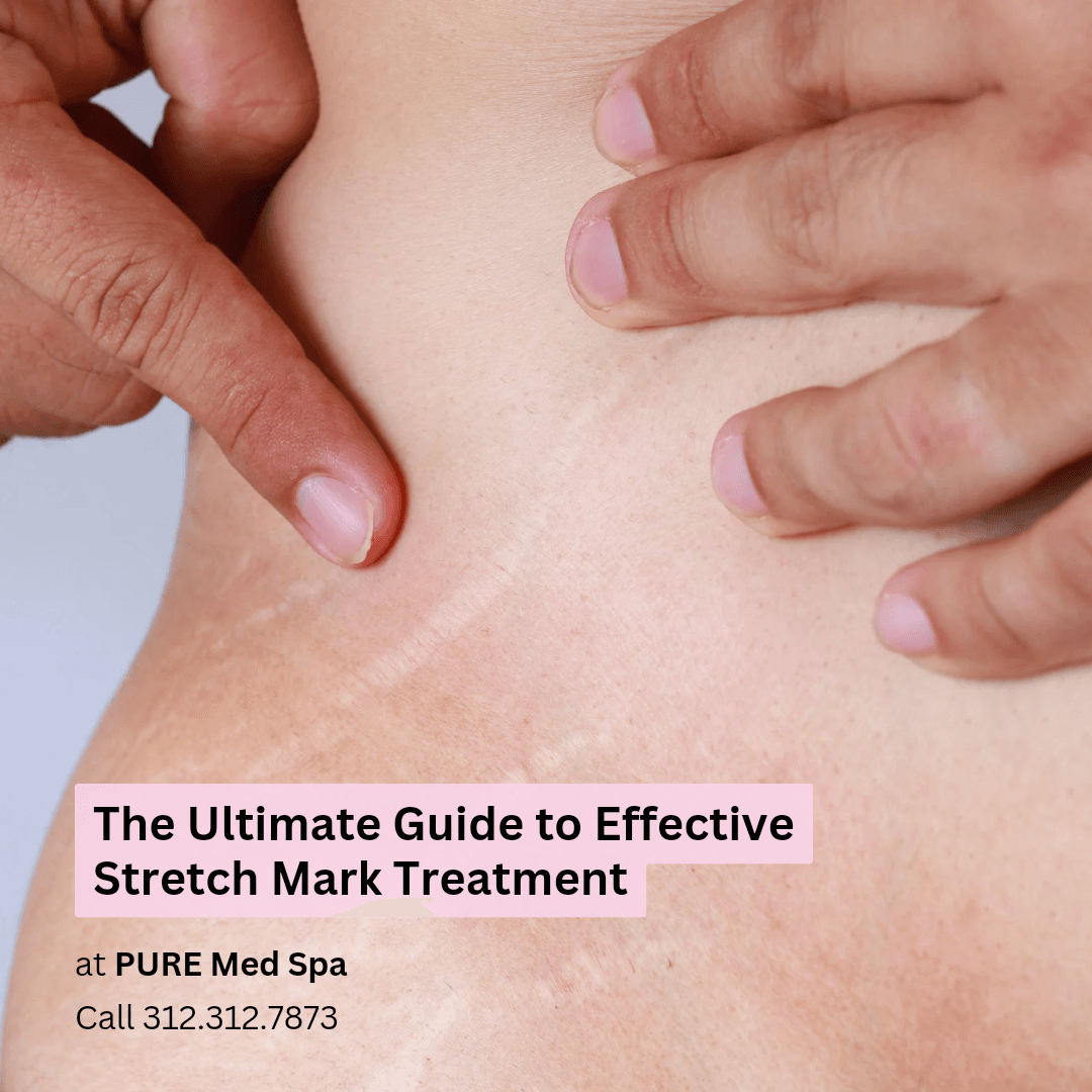The Ultimate Guide to Effective Stretch Mark Treatment - PURE Medical Spa